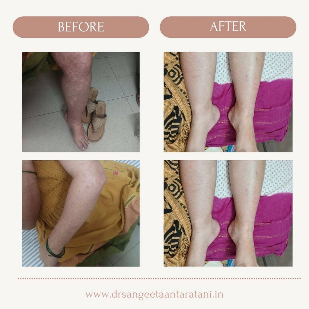 A Case of Polymorphic Eruption of Pregnancy (PEP) Treated by Dr ...